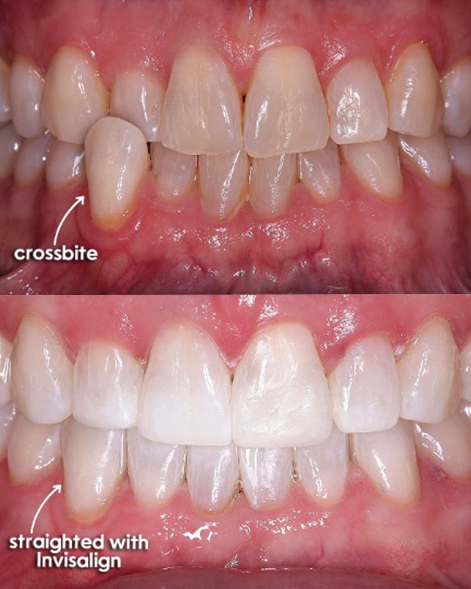 Invisalign Leigh-on-sea From £85 Per Month | Wisdom Dental