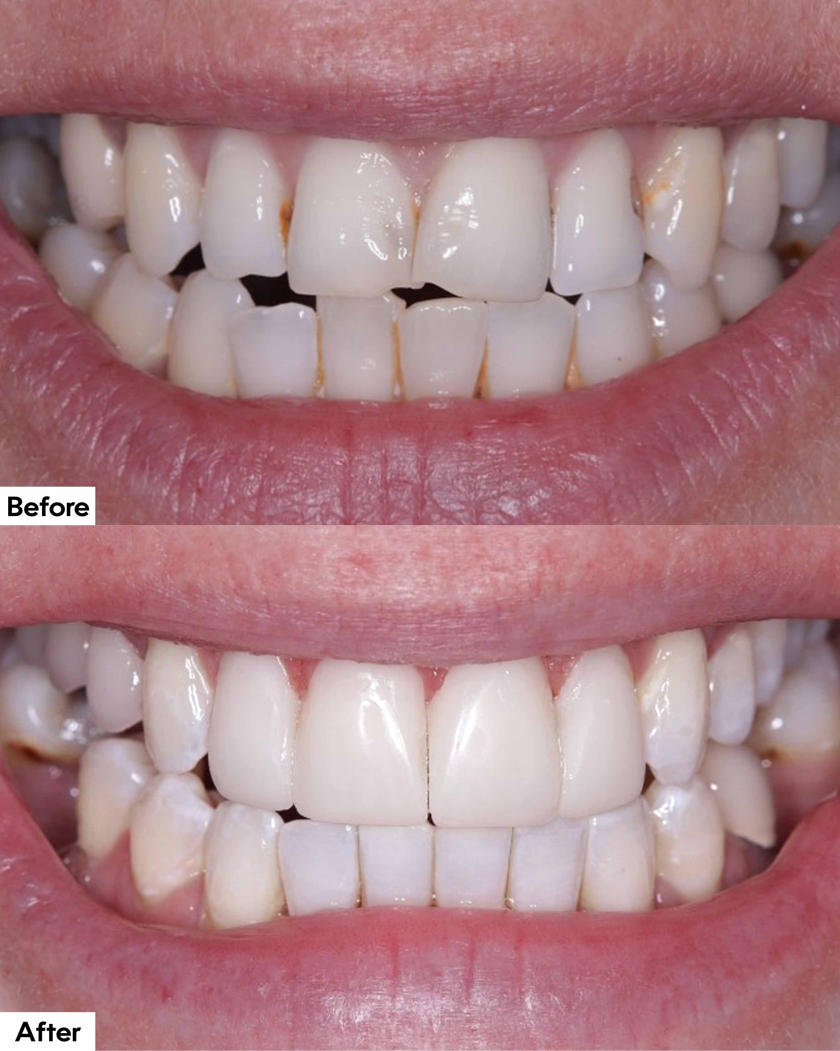 Invisalign Leigh-on-sea From £85 Per Month | Wisdom Dental