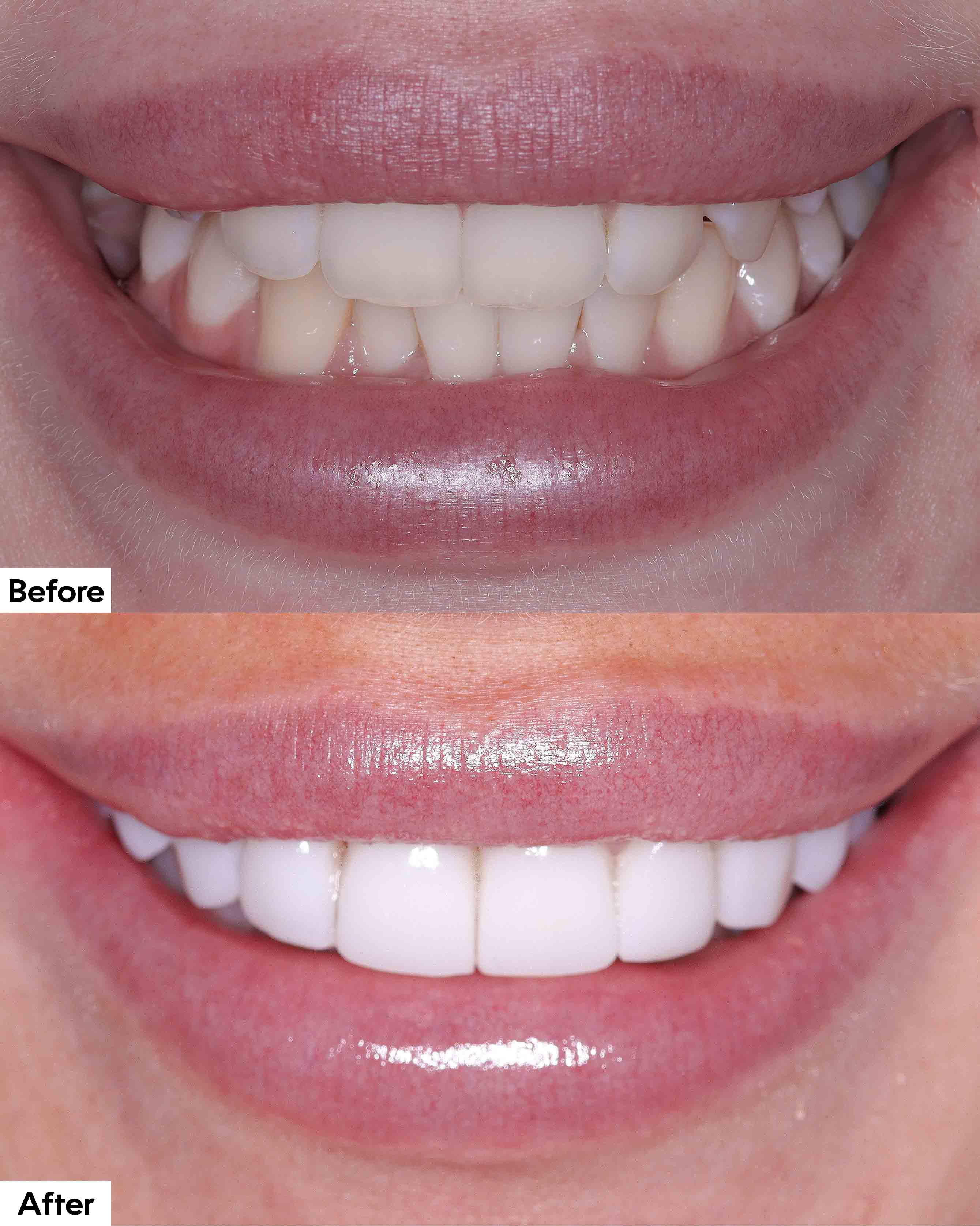 Invisalign Leigh-on-sea From £85 Per Month | Wisdom Dental